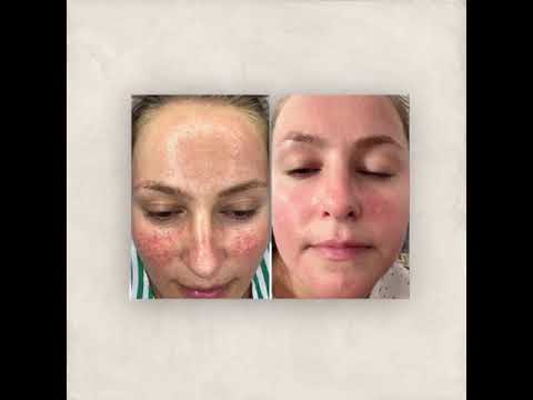 Gül hastalığının devası Soolantra krem