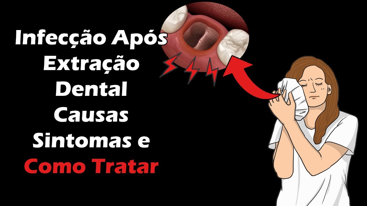 Infecção Após Extração de Dente - Alveolite - Sintomas, Causas e Como ...