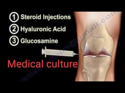 Cartilage Repair with Arthrex® BioCartilage® (Knee) and Medical culture ...