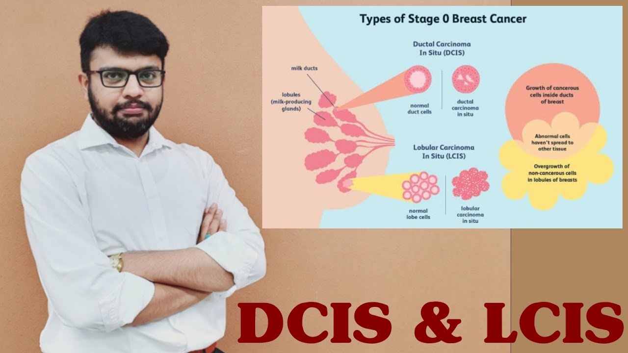 Ductal Carcinoma Insitu (DCIS) & Lobular Carcinoma Insitu LCIS | Breast ...