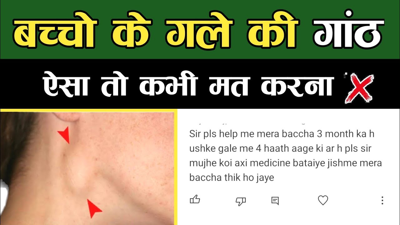 गर्दन में गांठ होने पर कब चिंता करें ? bacho k gale ki ganth | gale me ...