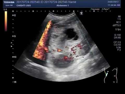 Ultrasound Video showing a large mass in the renal angle. - YouTube