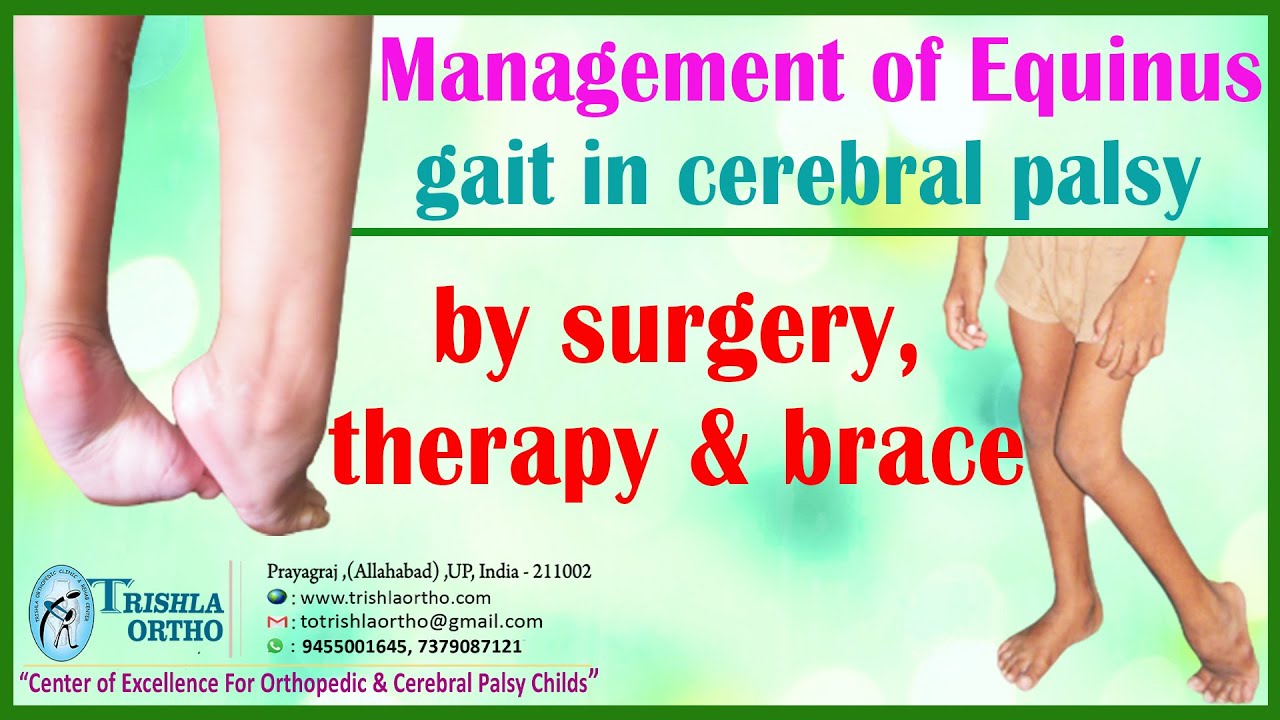 Management of Equinus gait in cerebral palsy - YouTube