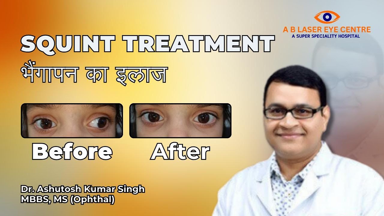 'Squint treatment’ opinion of the best squint specialist# ...