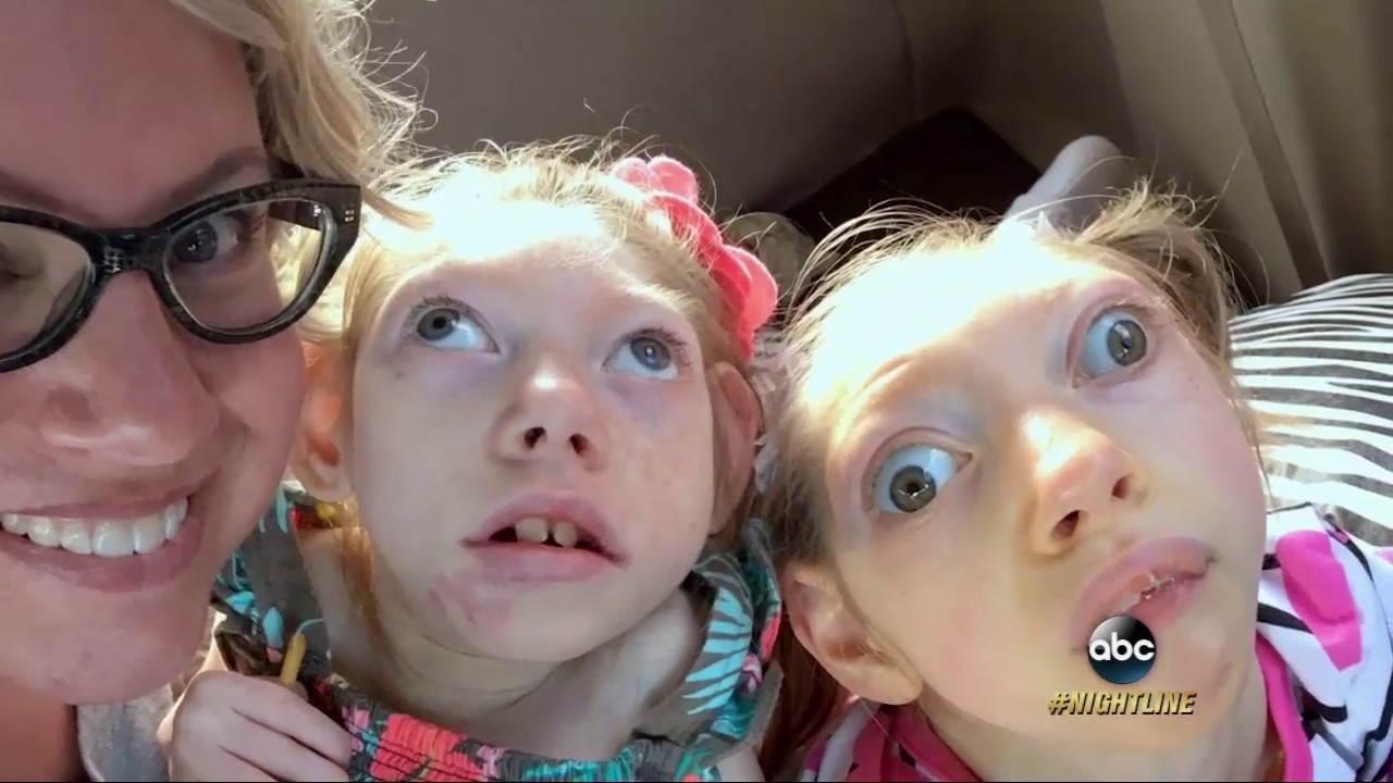 Kansas Parents of 2 Girls With Microcephaly Share Joys, Struggles of Family Life - YouTube