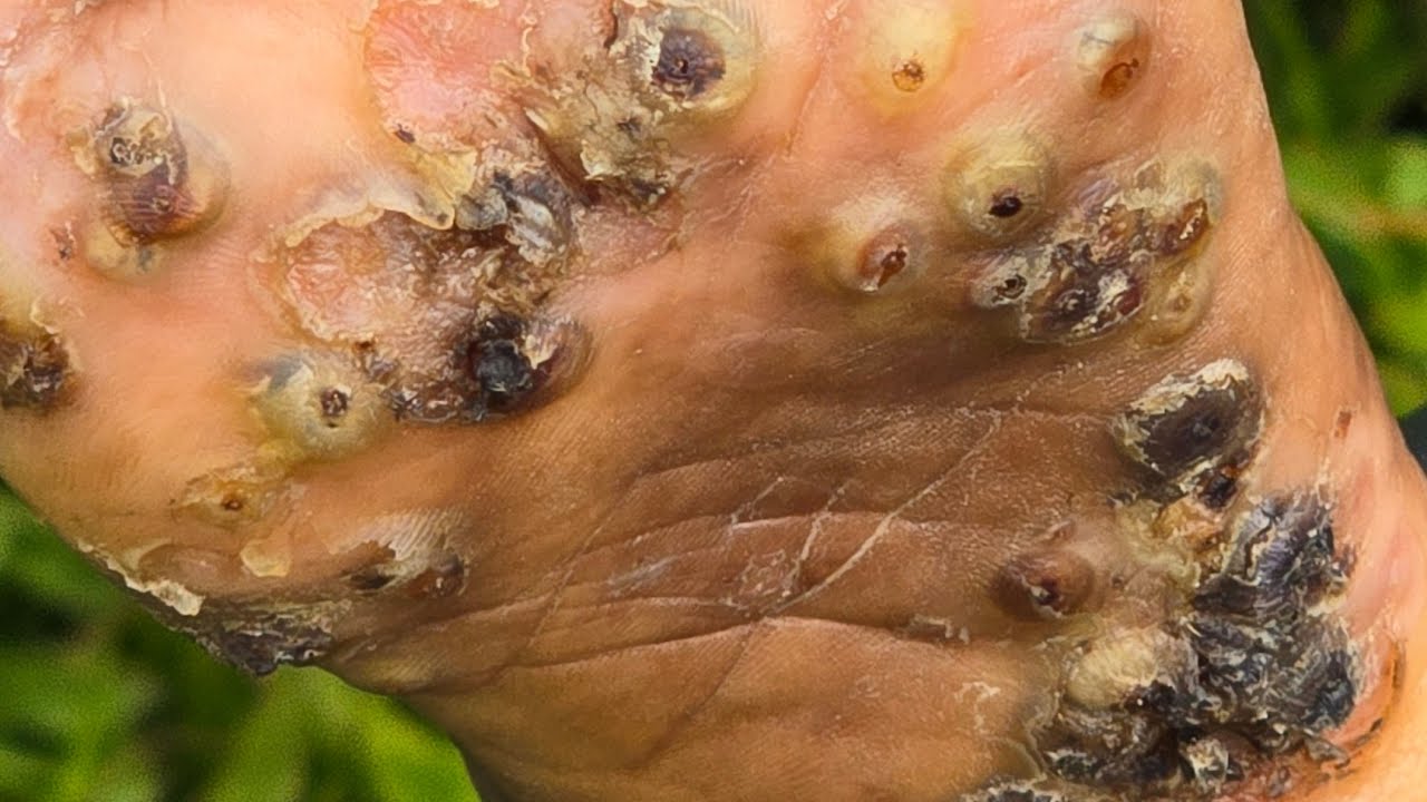 Little Peter Ayub's fat, clear bugs extracted #1 - get long vids @ riseupsociety.net & ruskenya ...