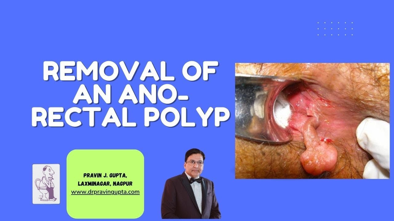 SURGERY OF AN ANO-RECTAL POLYP - YouTube