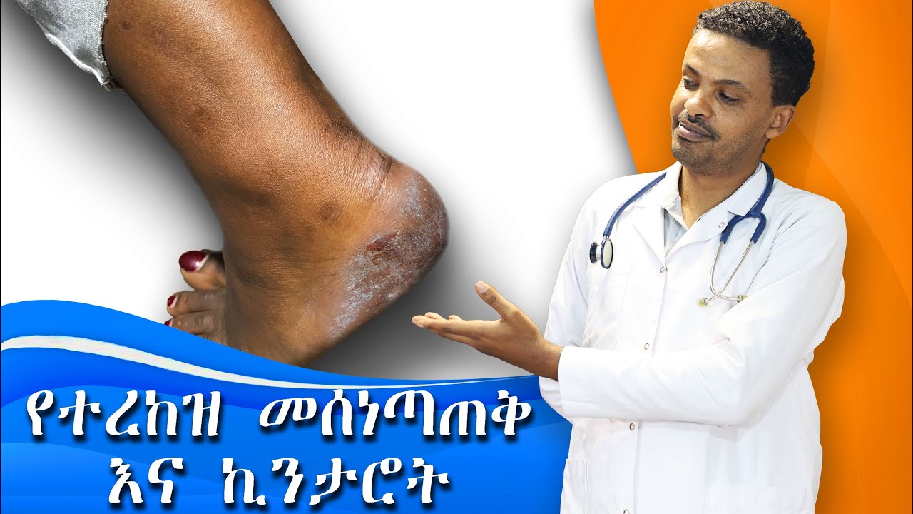የተሰነጣጠቀ ተረከዝ እና ኪንታሮት ለሚያስቸግረው | Heel fissure, callus and corn | Dr ...