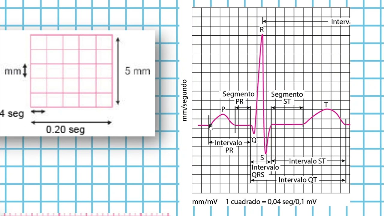 Morfología normal del EKG (Clases EKG #6) - YouTube