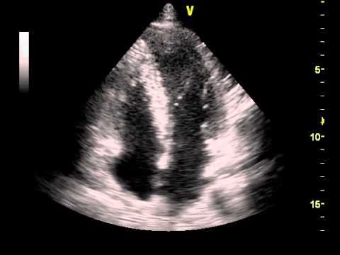 Normal 4 chamber view - YouTube