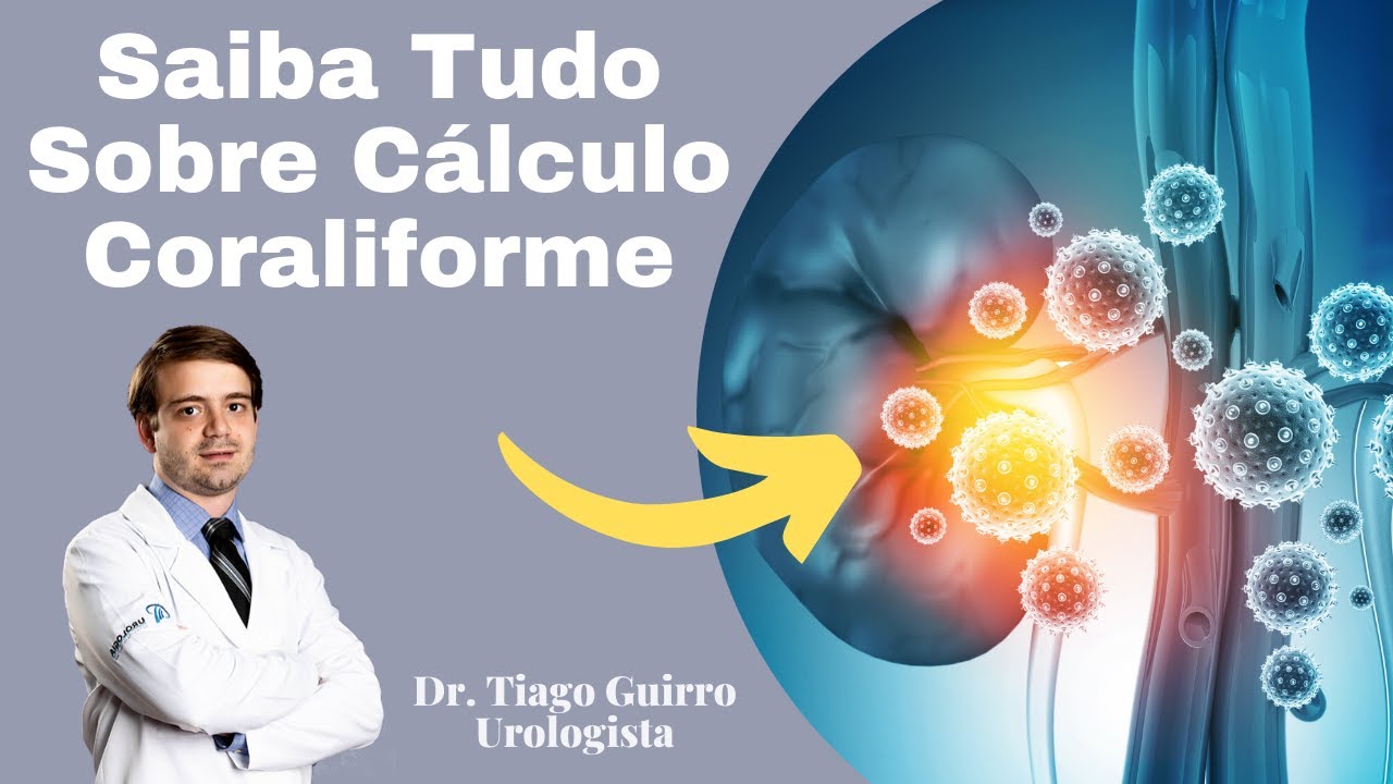 Saiba Tudo Sobre Cálculo Coraliforme - Uma pedra no rim grande! - YouTube