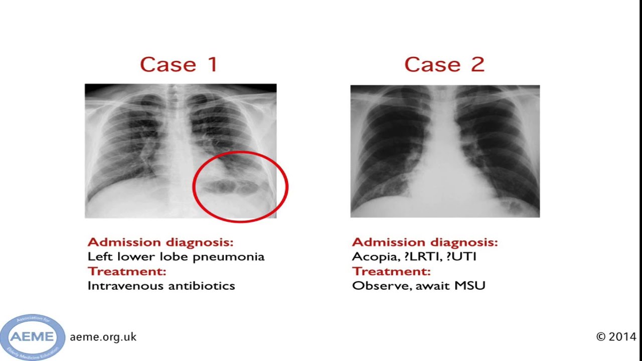 Acopia - the diagnosis for docs who can't cope - YouTube
