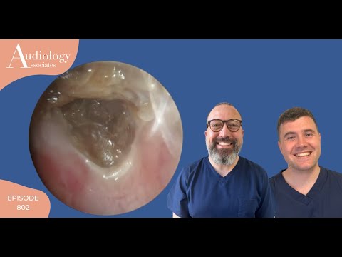 SKIN ENCASED EAR WAX PLUG REMOVAL- EP802 - YouTube