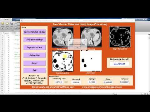 Matlab Code for Liver Cancer Detection Using Image Processing Full ...