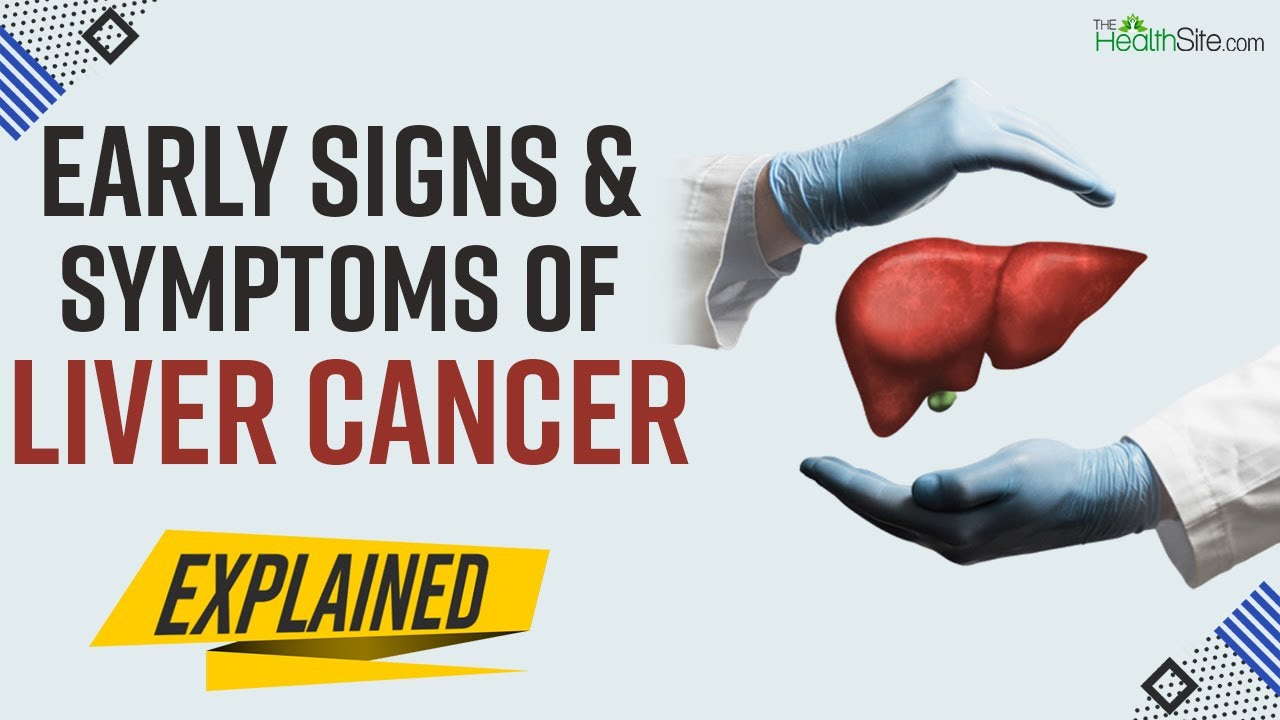 World Liver Day: Signs and Symptoms of Liver Cancer- Watch Video - YouTube
