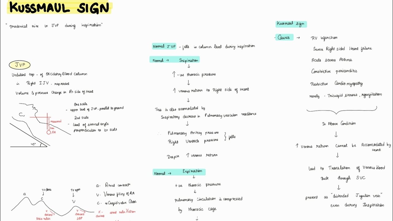 Kussmaul sign - Mechanism and Causes - YouTube