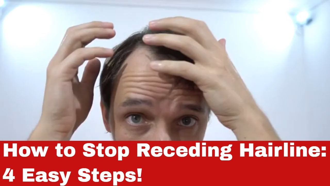 Hairline Running Away? Here's How to Stop Receding Hairline! - YouTube