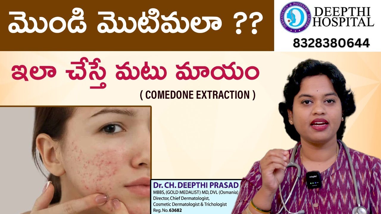 Comedone Extraction for Acne || Dr Deepthi Prasad || Dermatologist ...