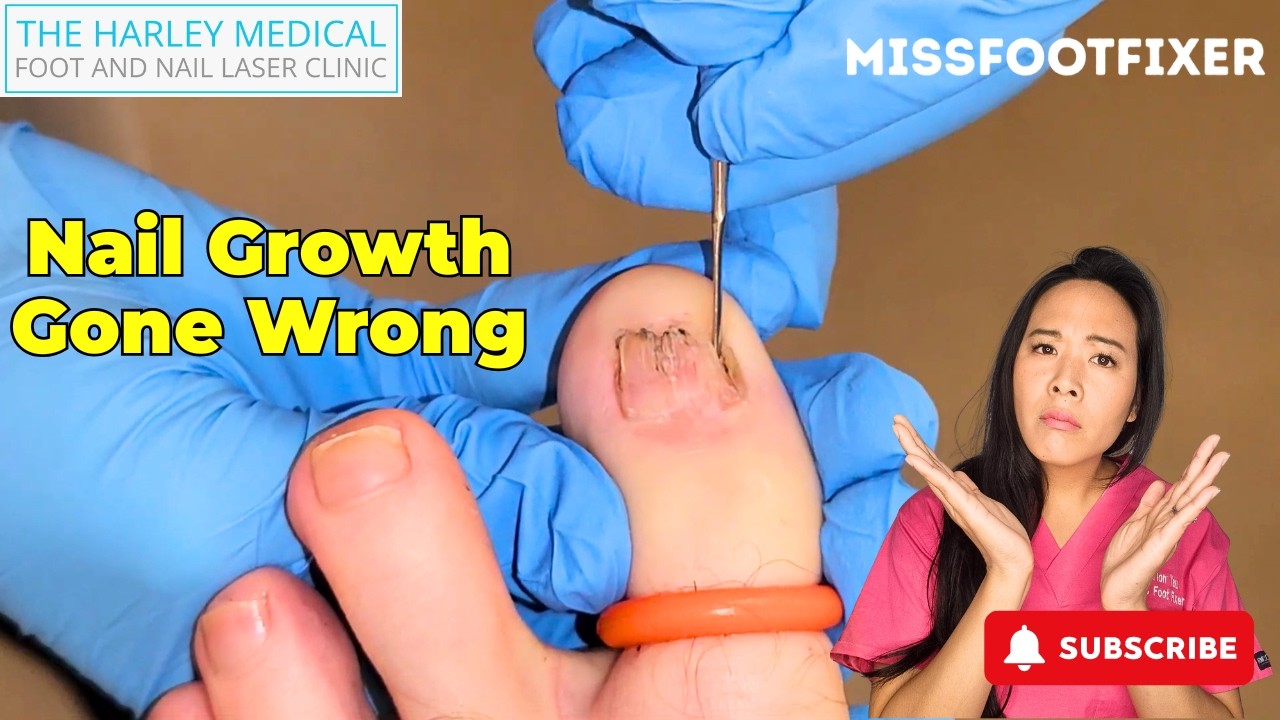 Thin Toenail Removal & Regrowth Assessment | Podiatry Procedure by Miss ...