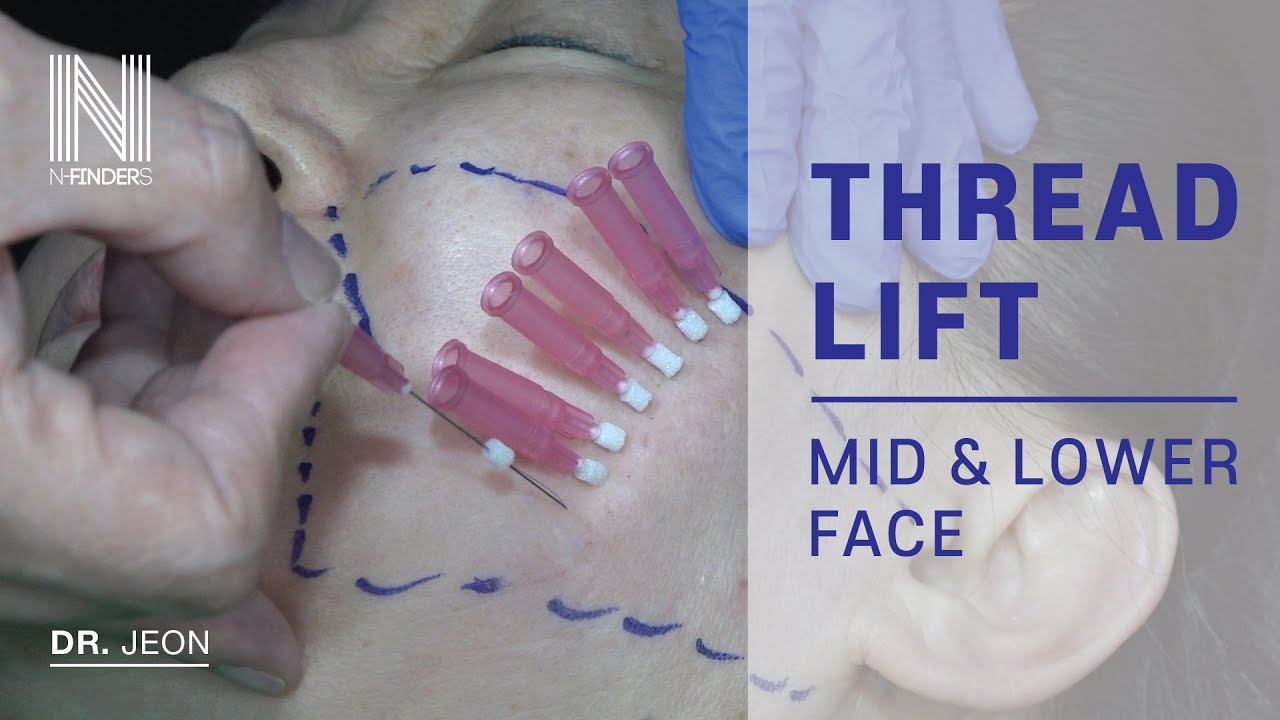 Mid & Lower face Thread Lift | N-Scaffold & Monofilament - YouTube