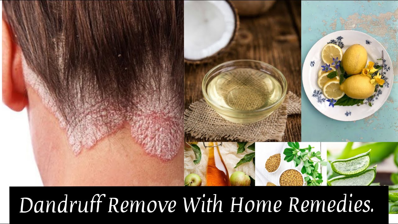 How To Get Rid Of Dandruff With Home Remedies. #truefoxy #homemade # ...