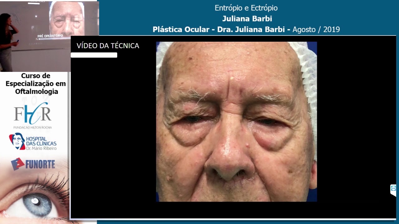 Entropio e Ectropio - Dr. Juliana Barbi - Plástica Ocular - YouTube