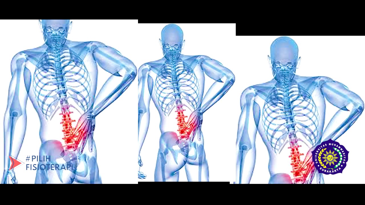 Penatalaksanaan Fisioterapi Pada Kasus Low Back Pain Myogenic - YouTube
