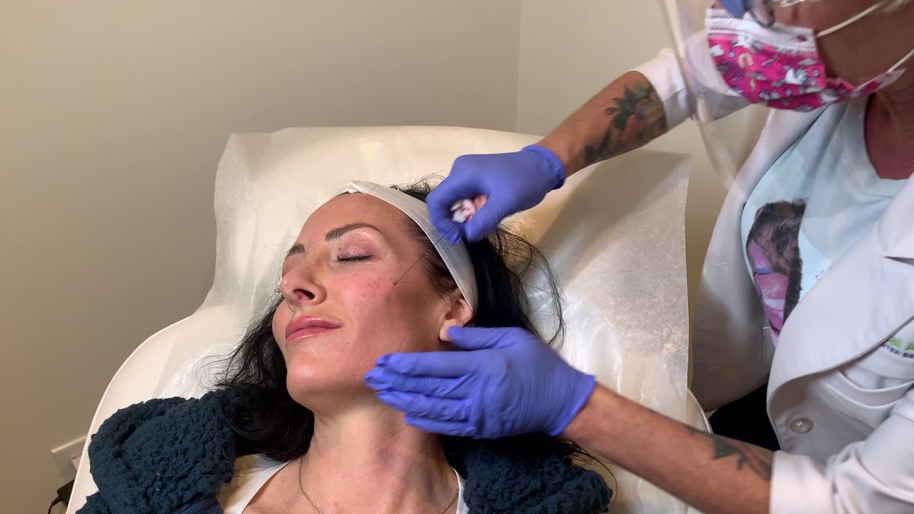 Thread Lifting and Collagen Stimulation in Seattle at Well Medical Arts ...