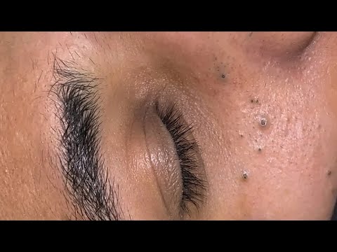 Deep Cleansing [ASMR] Facial for Acne & Blackhead Removal | Satisfying