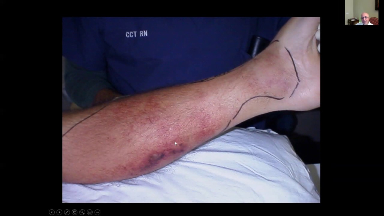 Diagnosis and Treatment of Necrotizing Skin Infections - YouTube