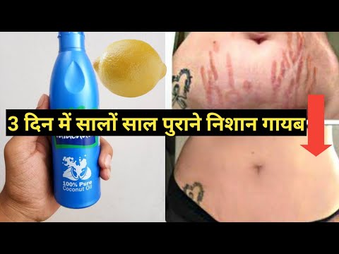 3 दिन में पुराने से पुराने स्ट्रेच मार्क्स को जड़ से खत्म कर देगा ये अद्भुत नुस्खा | #StretchMarks