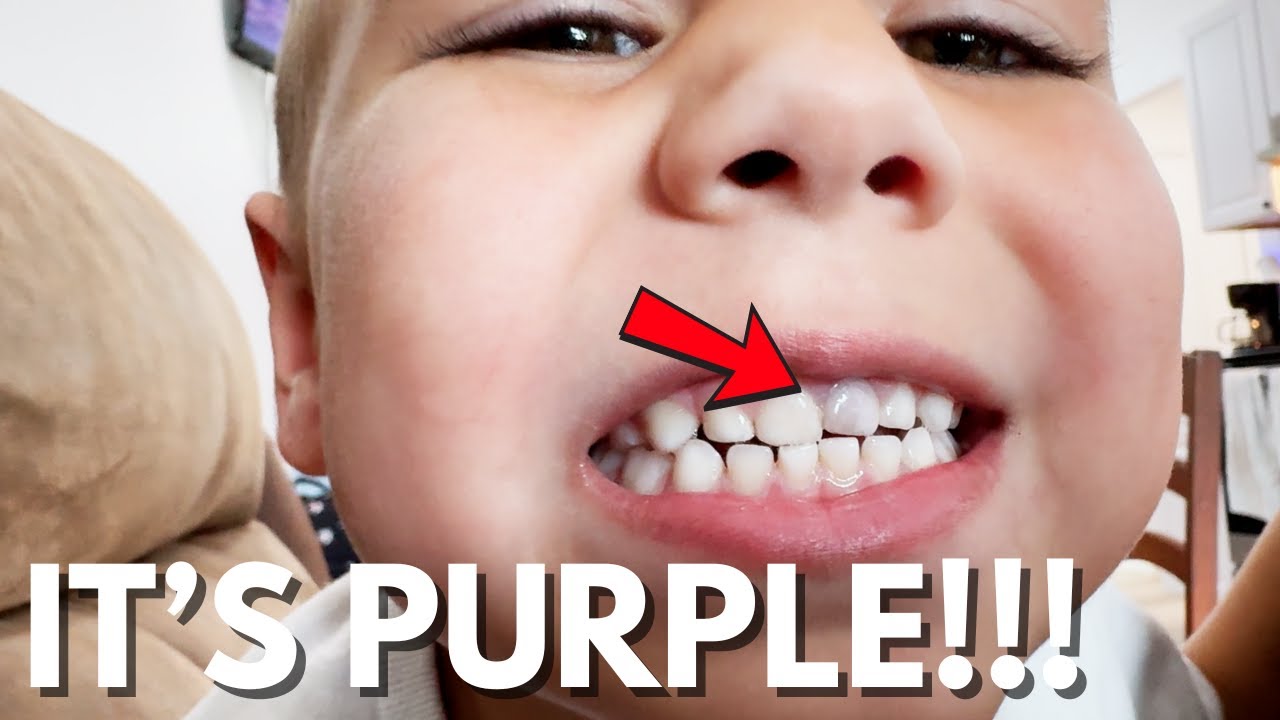 Why Is His Tooth PURPLE?! 😱 Will It Ever Go Away? | Family Vlog - YouTube