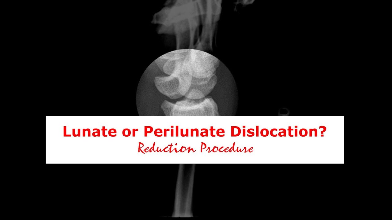 Perilunate And Lunate Dislocation Types