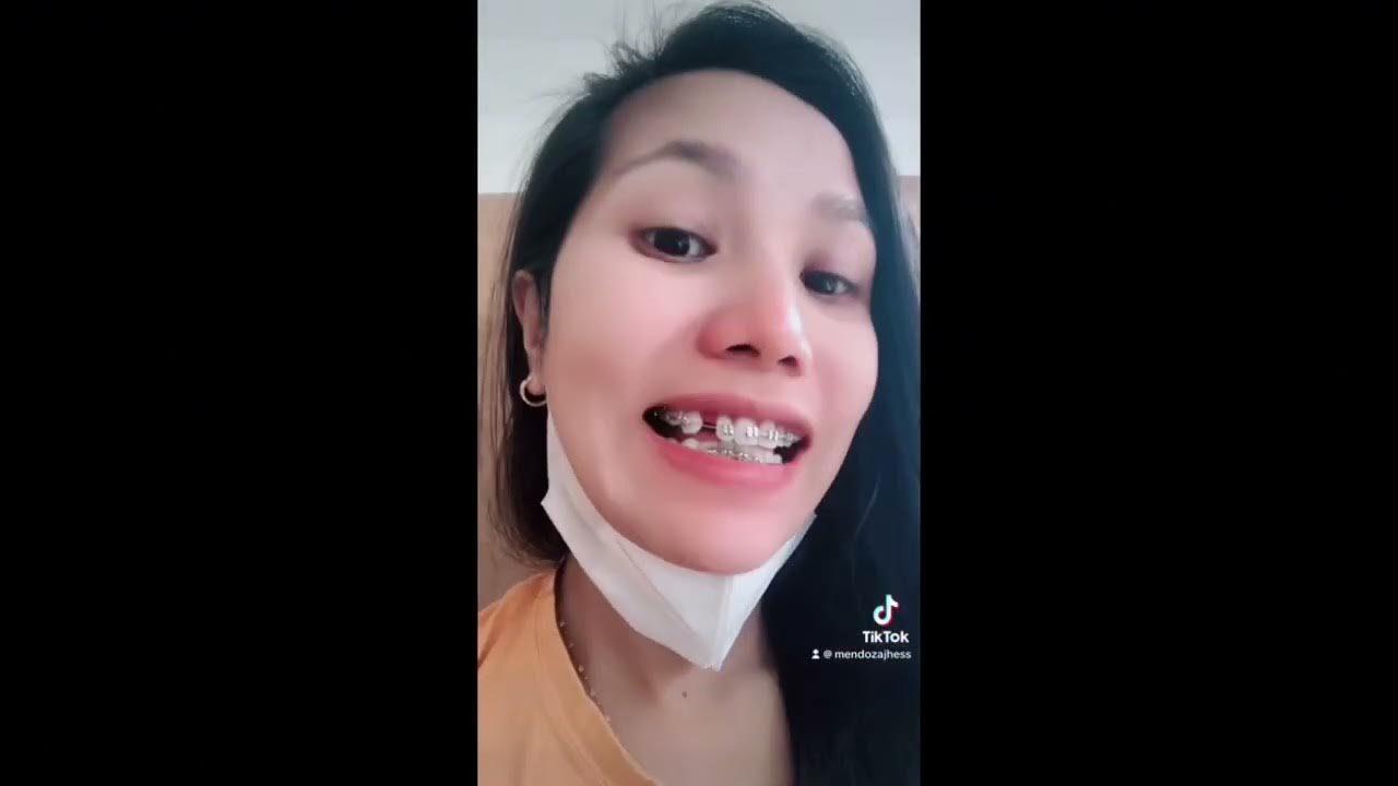 Adjust ng brace ba kamo🤔 - YouTube