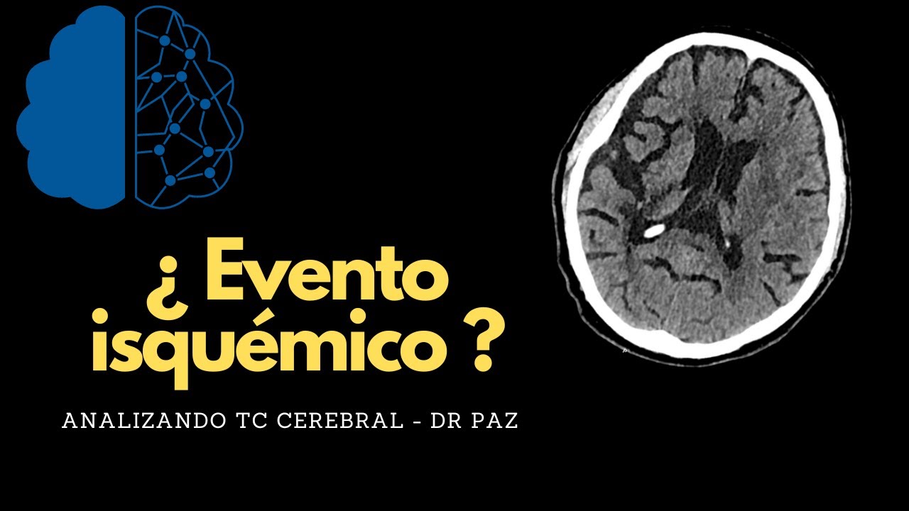 ¿Tendrá un evento isquémico cerebral? Analizando una TC cerebral - YouTube