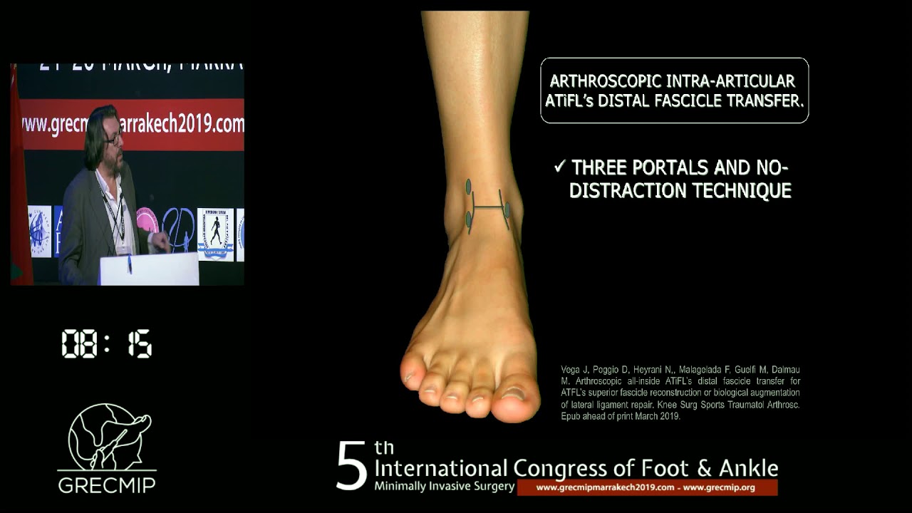 Arthroscopic all-inside ATiFL transfer - YouTube