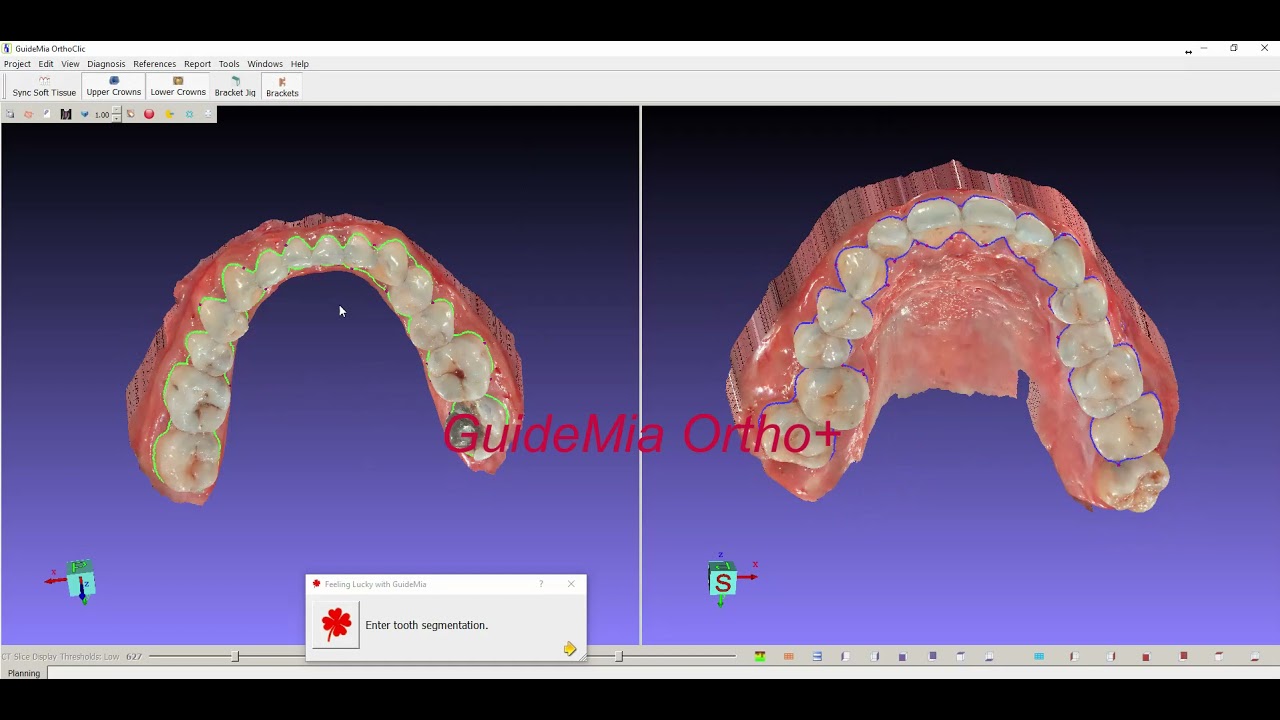 Ortho Design with GuideMia OrthoClic in 150 Seconds - YouTube
