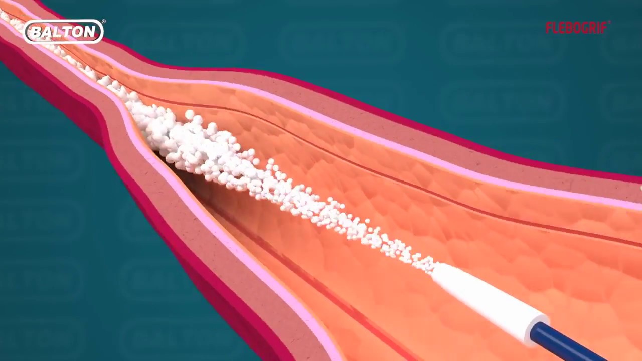 Usuwanie żylaków metodą Flebogrif - YouTube
