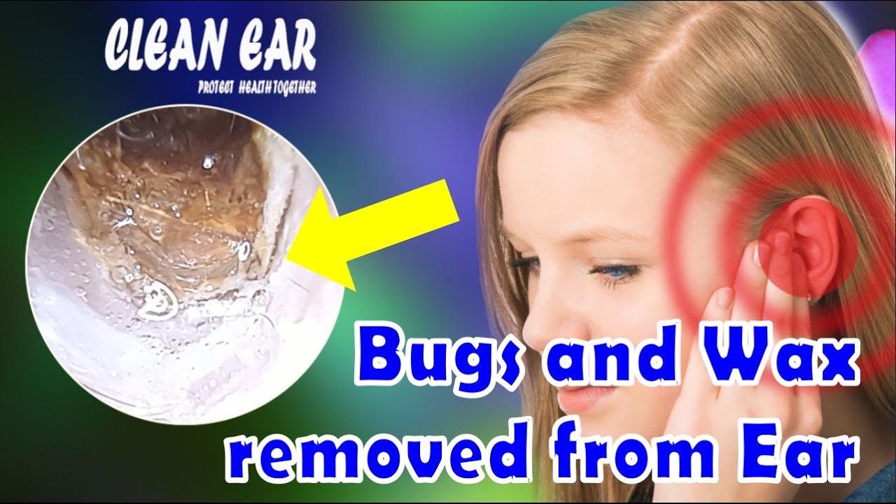 12 Bugs and Wax removed from Ear - YouTube