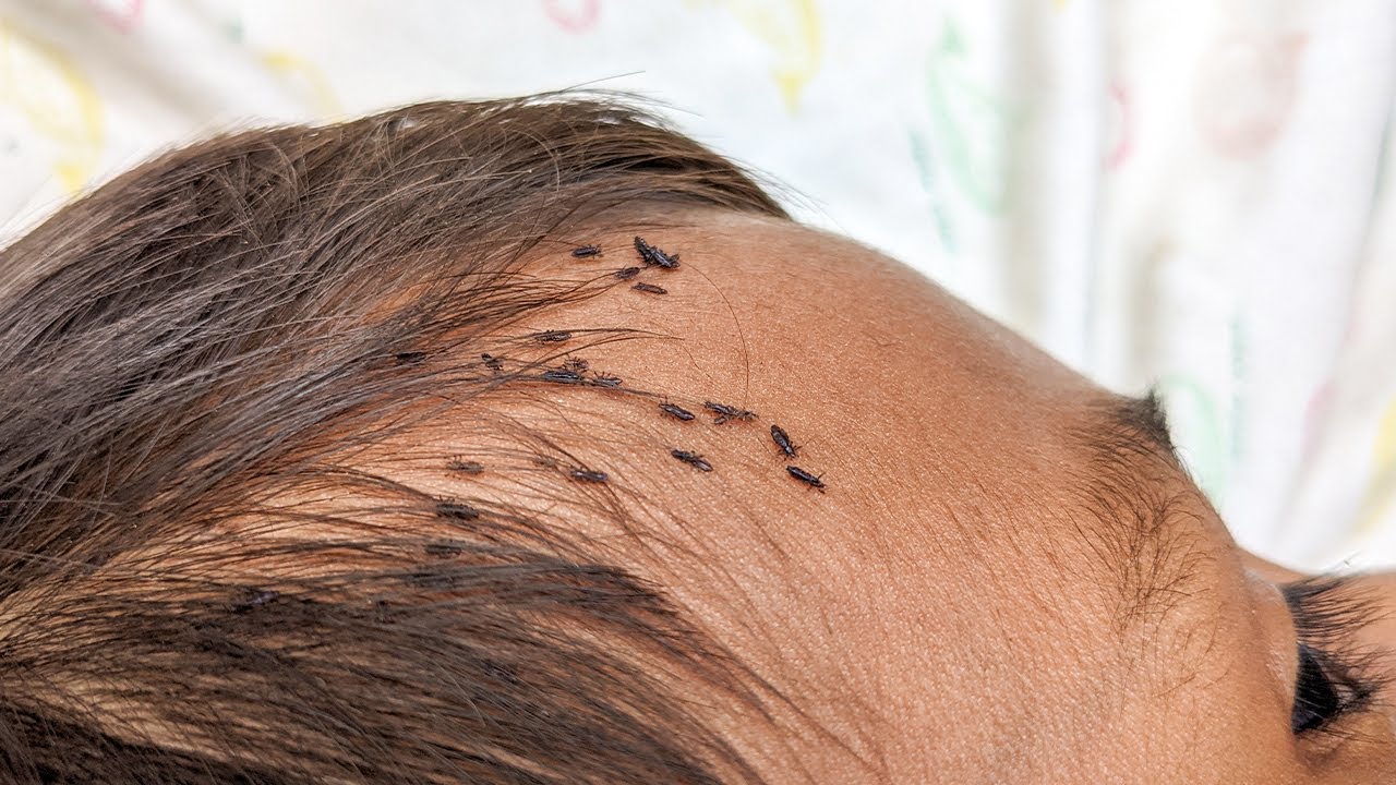 Comb a lot of big lice from my sister's hair - How clear head lice step ...