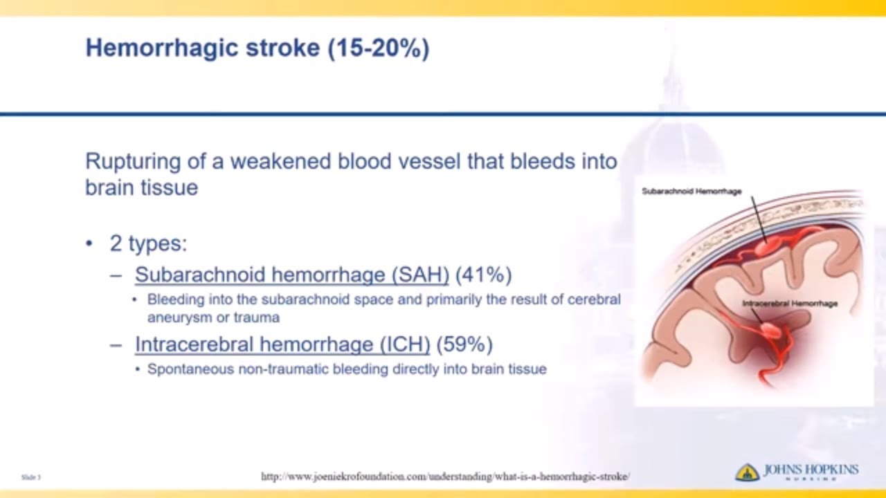 Hemorrhagic Stroke Lisa Klein YouTube