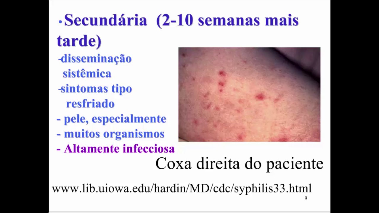 Aprenda Plugado - BACTERIOLOGIA - Aula 13, Slide 9 - Sifilis: lesão ...