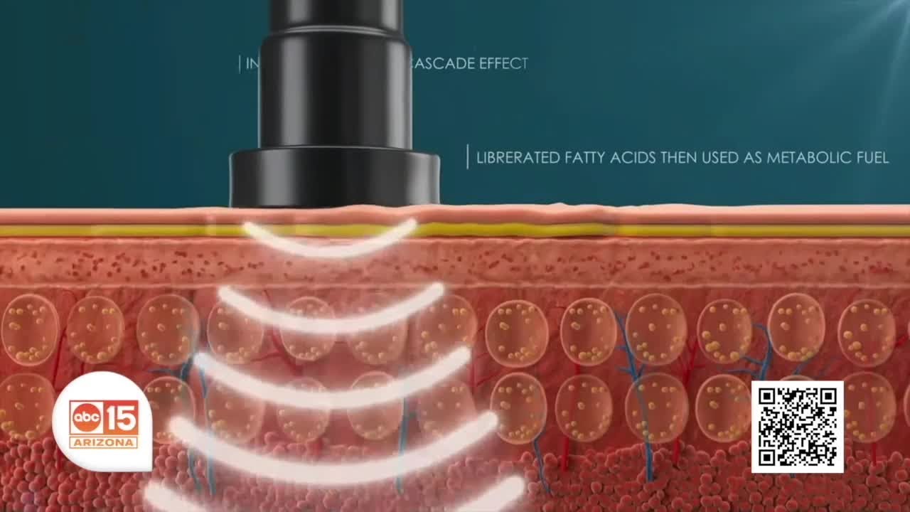 Redefine your shape and renew your confidence with Cellsound body ...