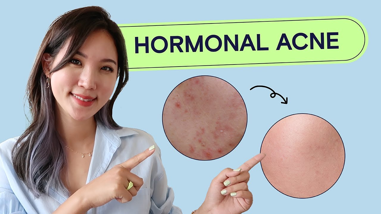 How To Treat Hormonal Acne | Acne School EP03 Health - YouTube
