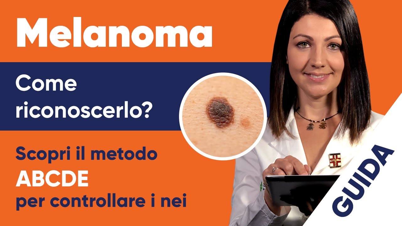 Melanoma della pelle: come riconoscerlo? Scopri il metodo ABCDE per ...