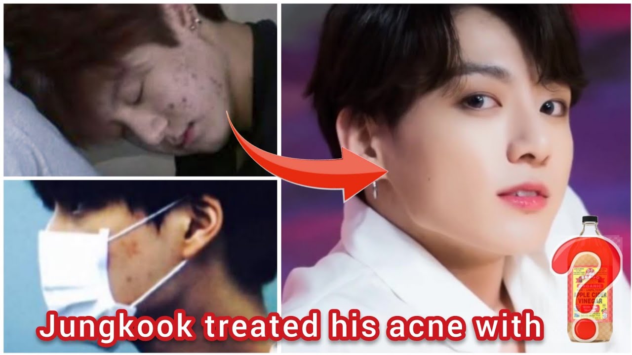 ACNE & PIMPLES | Korean Skin care - YouTube