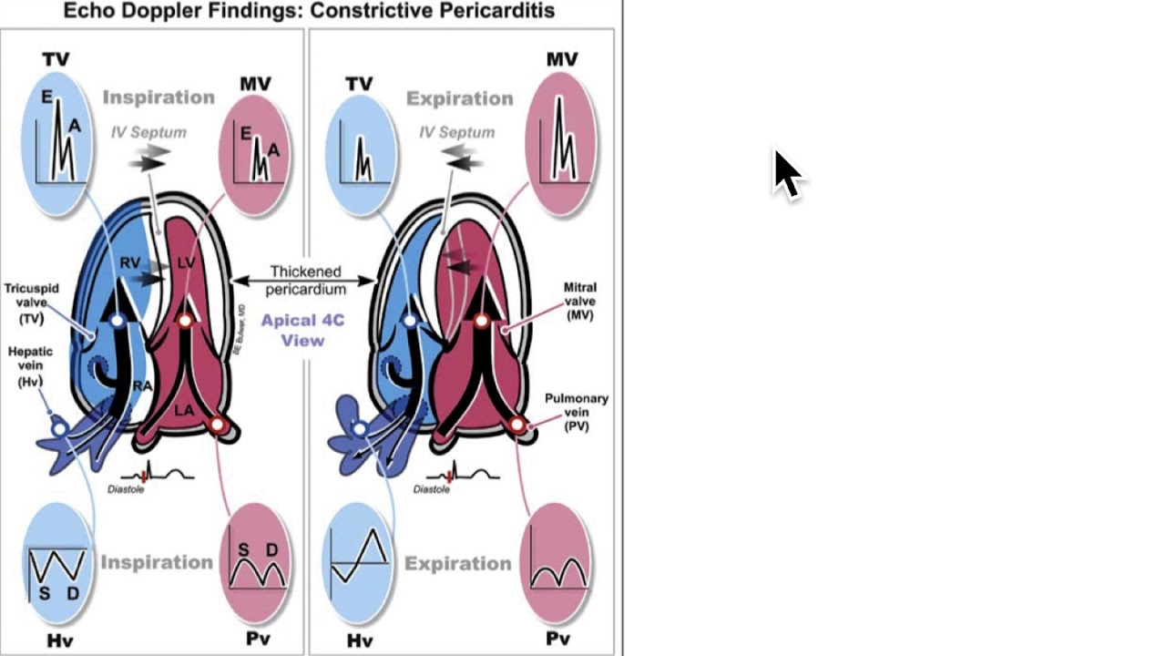 DIFERENCIANDO MIOCARDIOPATÍA RESTRICTIVA DE PERICARDITIS CONSTRICTIVA ...