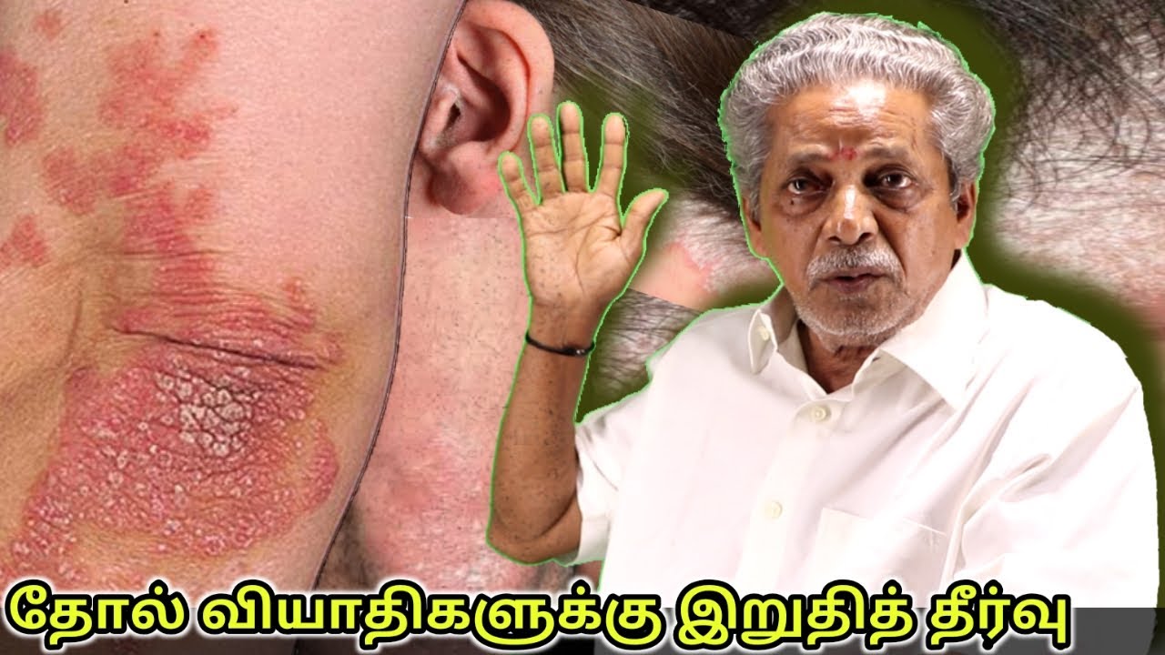 தோல் வியாதிகளுக்கு இறுதித்தீர்வு,அப்பா || skin diseases final solution ...
