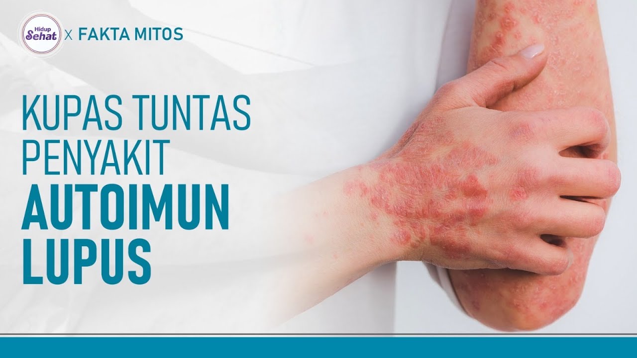 Kenali Gejala Lupus, Penyakit Autoimun Paling Umum Terjadi | Hidup ...