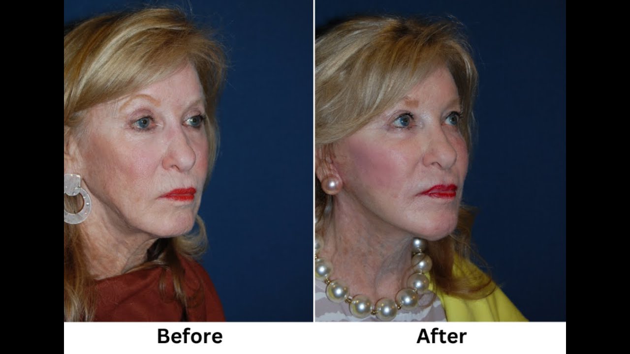 Top facial plastic surgeon in Charlotte- Dr. Sean Freeman